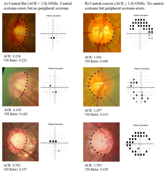 Optic Nerve Head Curvature Flattening Is Associated with Central Visual ...