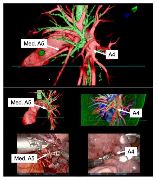 Developing a Virtual Reality Simulation System for Preoperative ...