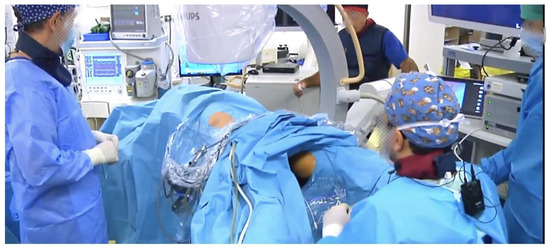 Nonpapillary Prone Endoscopic Combined Intrarenal Surgery (ECIRS): Five ...