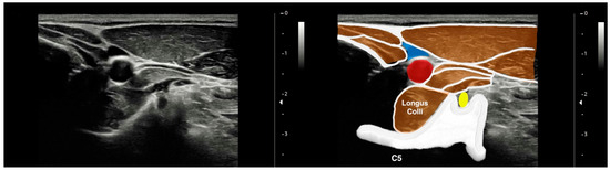 Cervical Multifidus and Longus Colli Ultrasound Differences among ...