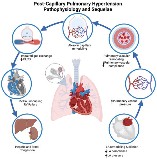 JCM | Free Full-Text | Post-Capillary Pulmonary Hypertension: Clinical Review