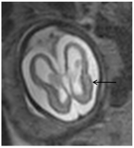 Cytomegalovirus and Pregnancy: A Narrative Review
