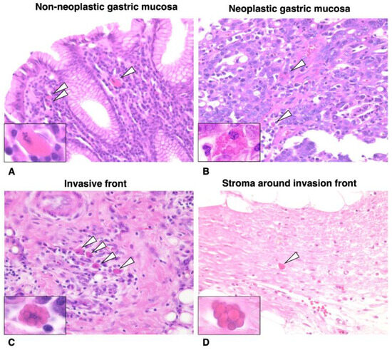 Distribution and Clinicopathological Features of Mott Cells (Plasma ...