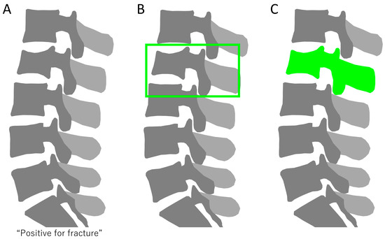 Machine Learning and Deep Learning in Spinal Injury: A Narrative Review ...
