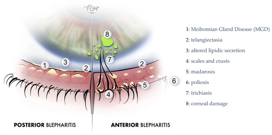 Uncommon Blepharitis