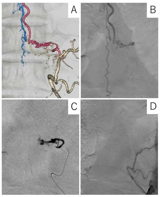 Delayed Diagnosis of Spinal Dural Arteriovenous Fistula: A Case Report ...
