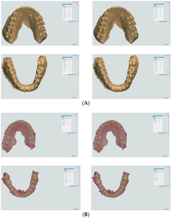 Comparison of Tooth Size Measurements in Orthodontics Using ...