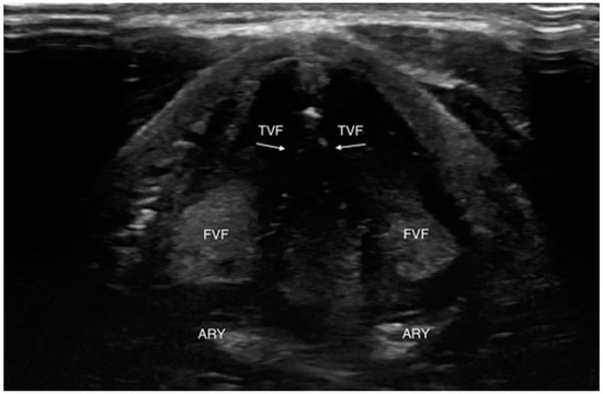 The Role of Pocus in Acute Respiratory Failure: A Narrative Review on ...