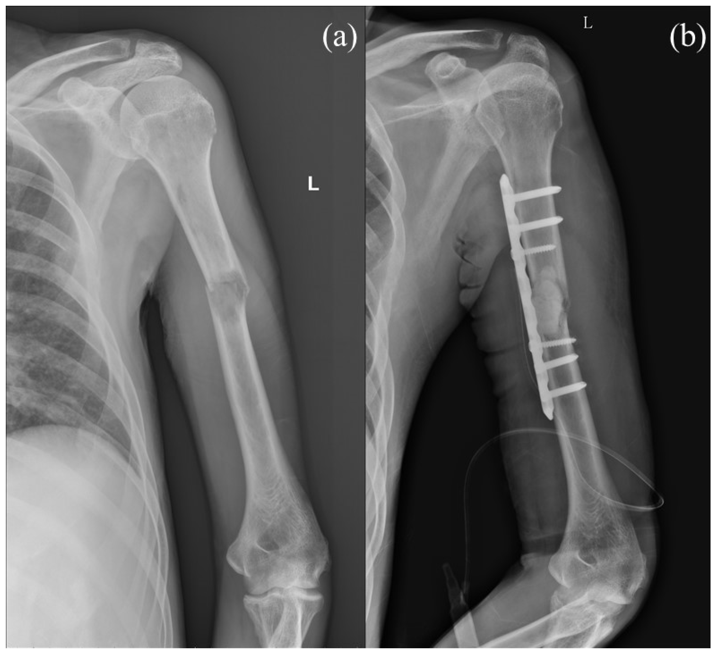 Intramedullary Nail vs. Plate Fixation for Pathological Humeral Shaft Fracture: An Updated ...