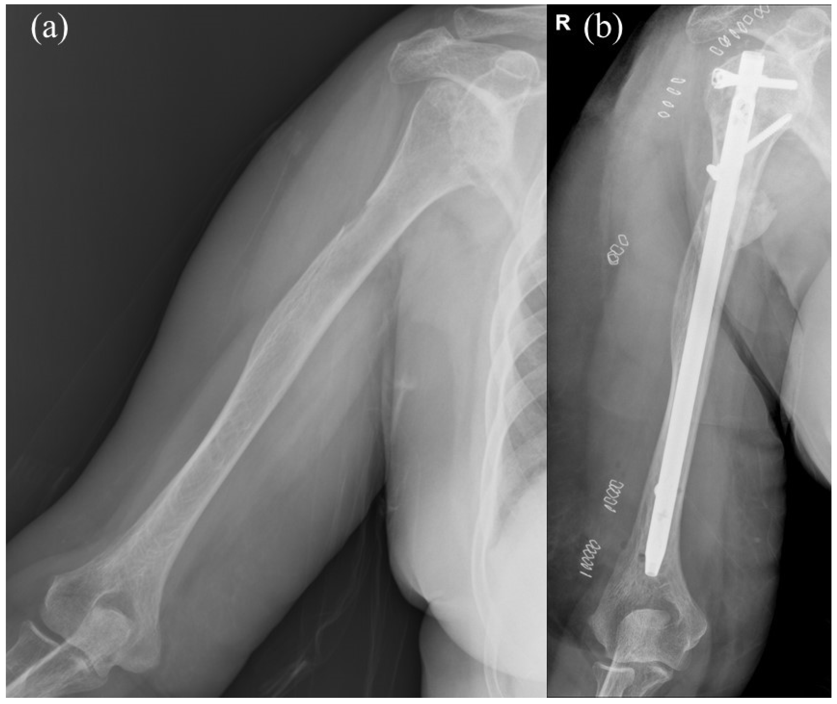 Intramedullary Nail vs. Plate Fixation for Pathological Humeral Shaft Fracture: An Updated ...