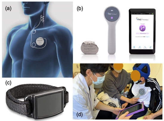 Vagus Nerve Stimulation Therapy for Drug-Resistant Epilepsy in Children ...