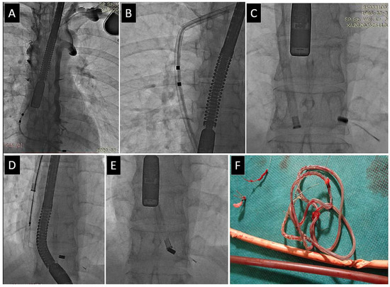 VDD Lead Extraction—Differences with Other Leads and Practical Tips in ...