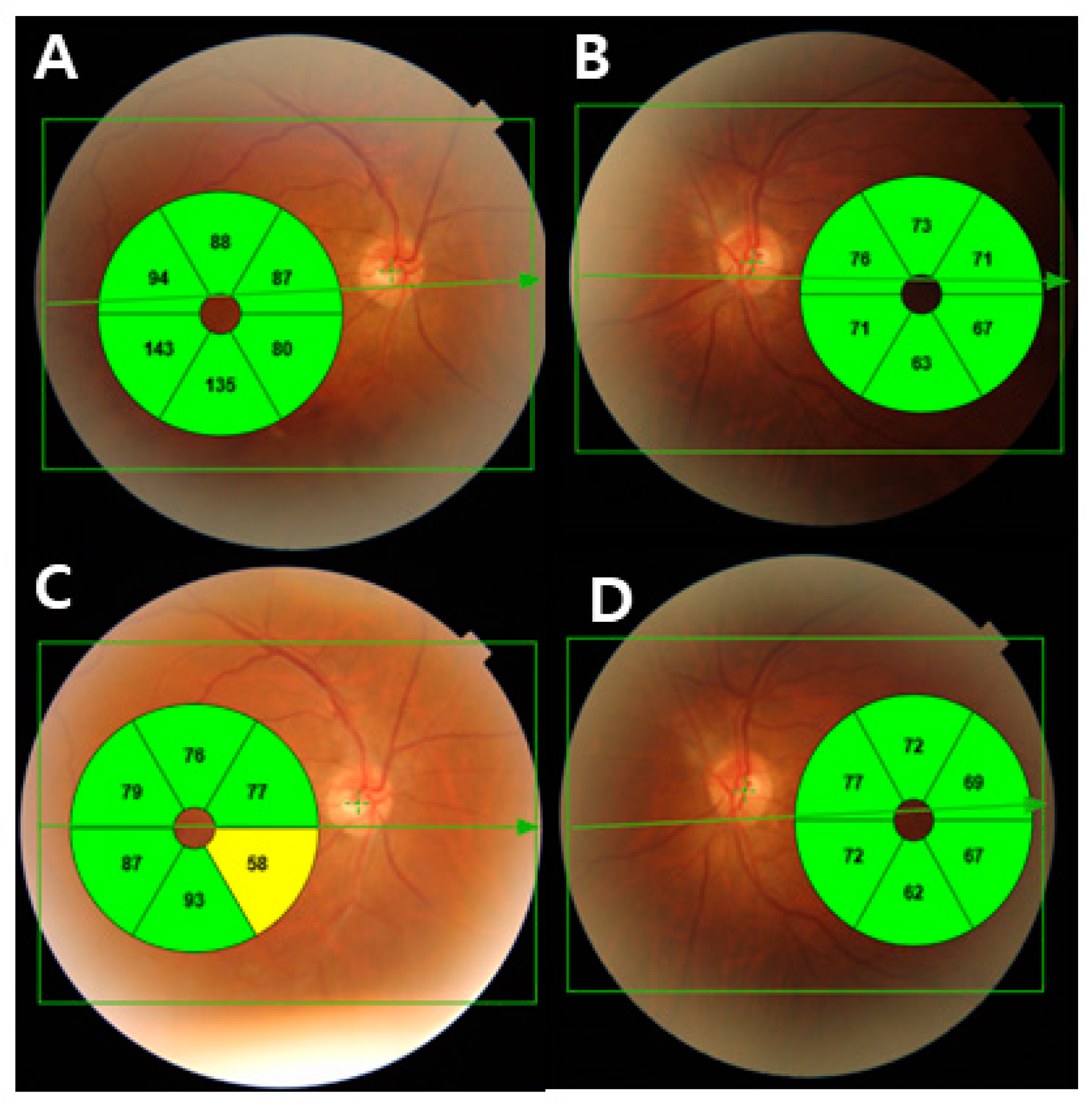 Changes in Neurodegeneration and Visual Prognosis in Branch Retinal ...