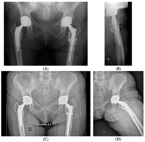 Results of Utilizing Cerclage Wires in the Management of Intraoperative ...