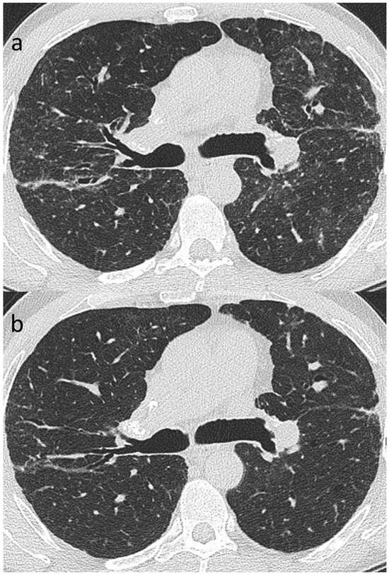 Imaging of Pulmonary Sarcoidosis—A Review