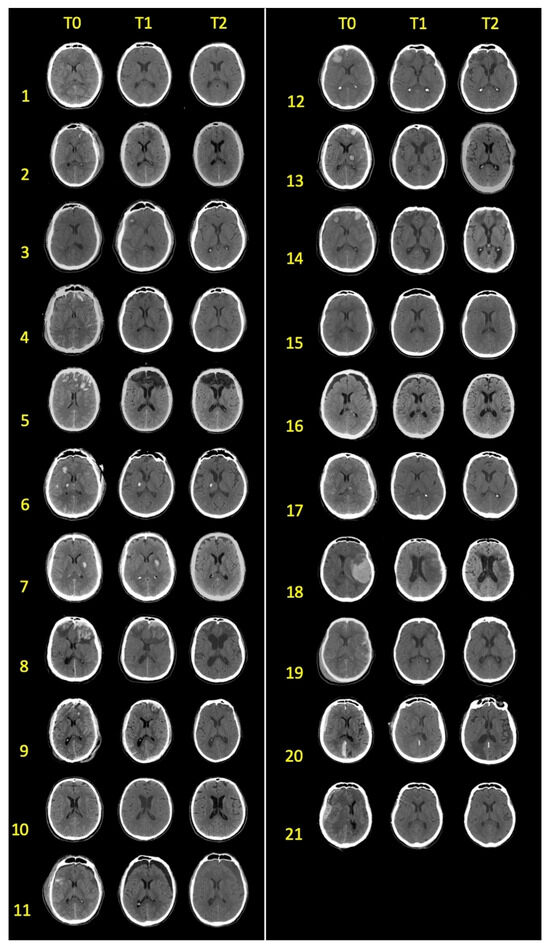 Evolution of Severe Closed Head Injury: Assessing Ventricular Volume ...