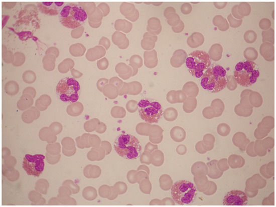Eosinophiles Bas Churg Strauss Syndrome In Childhood: A Clinical