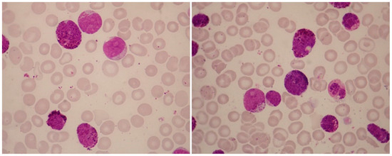 Approach to Acute Myeloid Leukemia with Increased Eosinophils and Basophils
