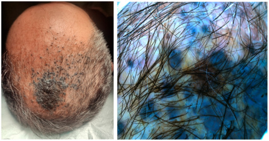 Diagnostic Imaging of Agminated Blue Lesions and Blue Lesions with ...