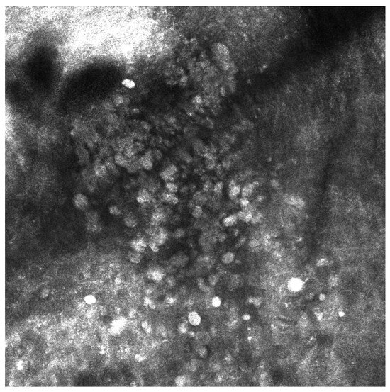 Diagnostic Imaging of Agminated Blue Lesions and Blue Lesions with ...