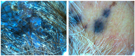 Diagnostic Imaging of Agminated Blue Lesions and Blue Lesions with ...