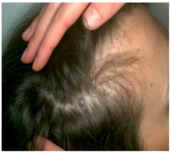 Diagnostic Imaging of Agminated Blue Lesions and Blue Lesions with ...