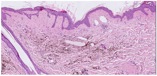 Diagnostic Imaging of Agminated Blue Lesions and Blue Lesions with ...
