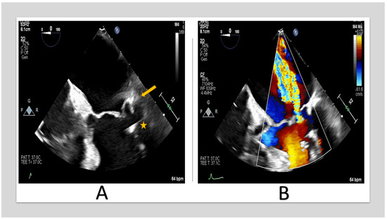 Mitral Annular Calcification-Related Valvular Disease: A Challenging Entity