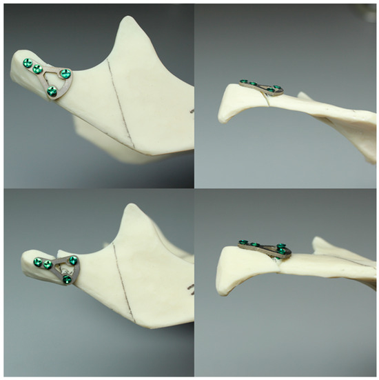 Optimal Plate Choice for High-Neck Mandibular Condyle Fracture: A ...