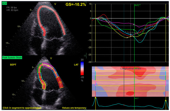 Reverse Septal Movement: A Step Forward in the Comprehension of the ...