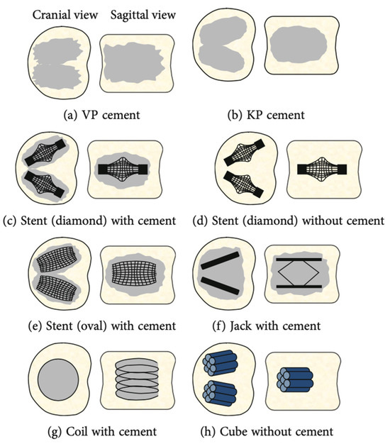 JCM | Free Full-Text | Multidisciplinary and Coordinated Management of Osteoporotic Vertebral ...