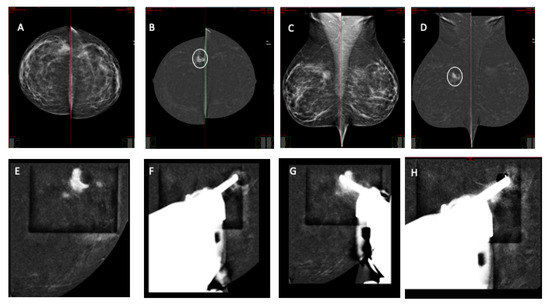 Contrast-Enhanced Mammography-Guided Biopsy: Preliminary Results of a ...