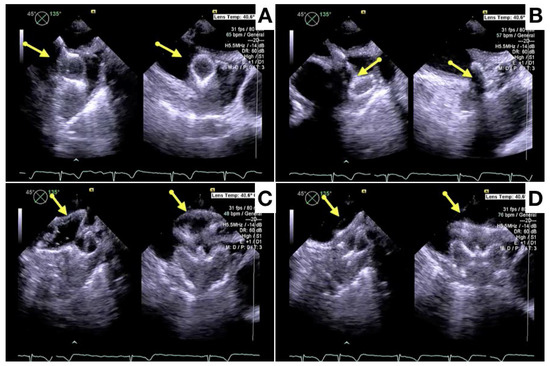 State-of-the-Art of Transcatheter Left Atrial Appendage Occlusion
