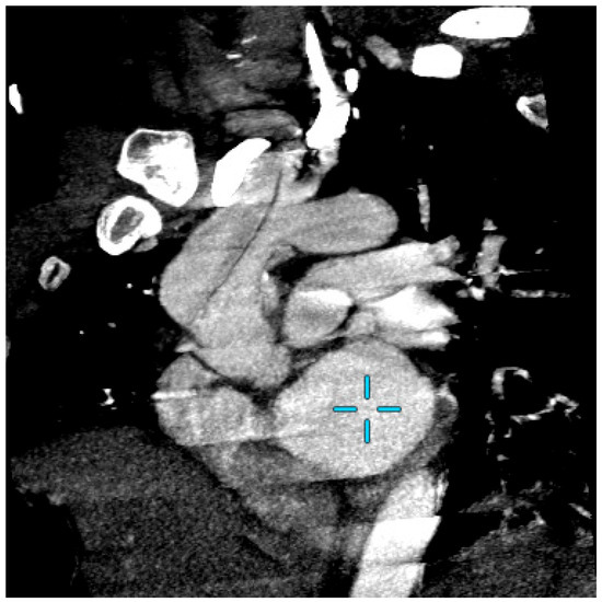 Late Post-Dissection Dynamic Intermittent Malperfusion of the Aortic ...