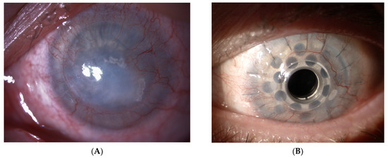Outcomes of Boston Keratoprosthesis Type I Implantation in Poland: A ...