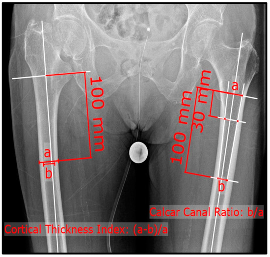 Cortical Thickness Index and Canal Calcar Ratio: A Comparison of ...