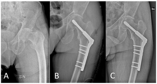 JCM | Free Full-Text | Angle-Adjustable Dynamic Hip Screw Plate for ...