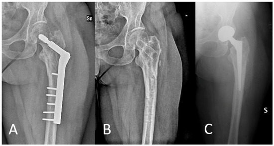 JCM | Free Full-Text | Angle-Adjustable Dynamic Hip Screw Plate for ...