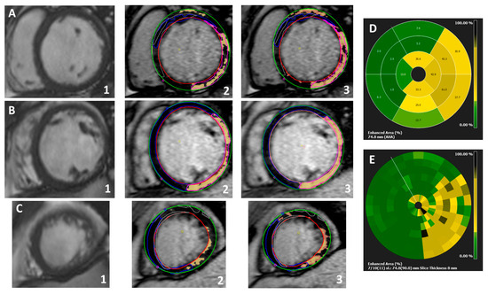 Current Insights and Novel Cardiovascular Magnetic Resonance-Based ...
