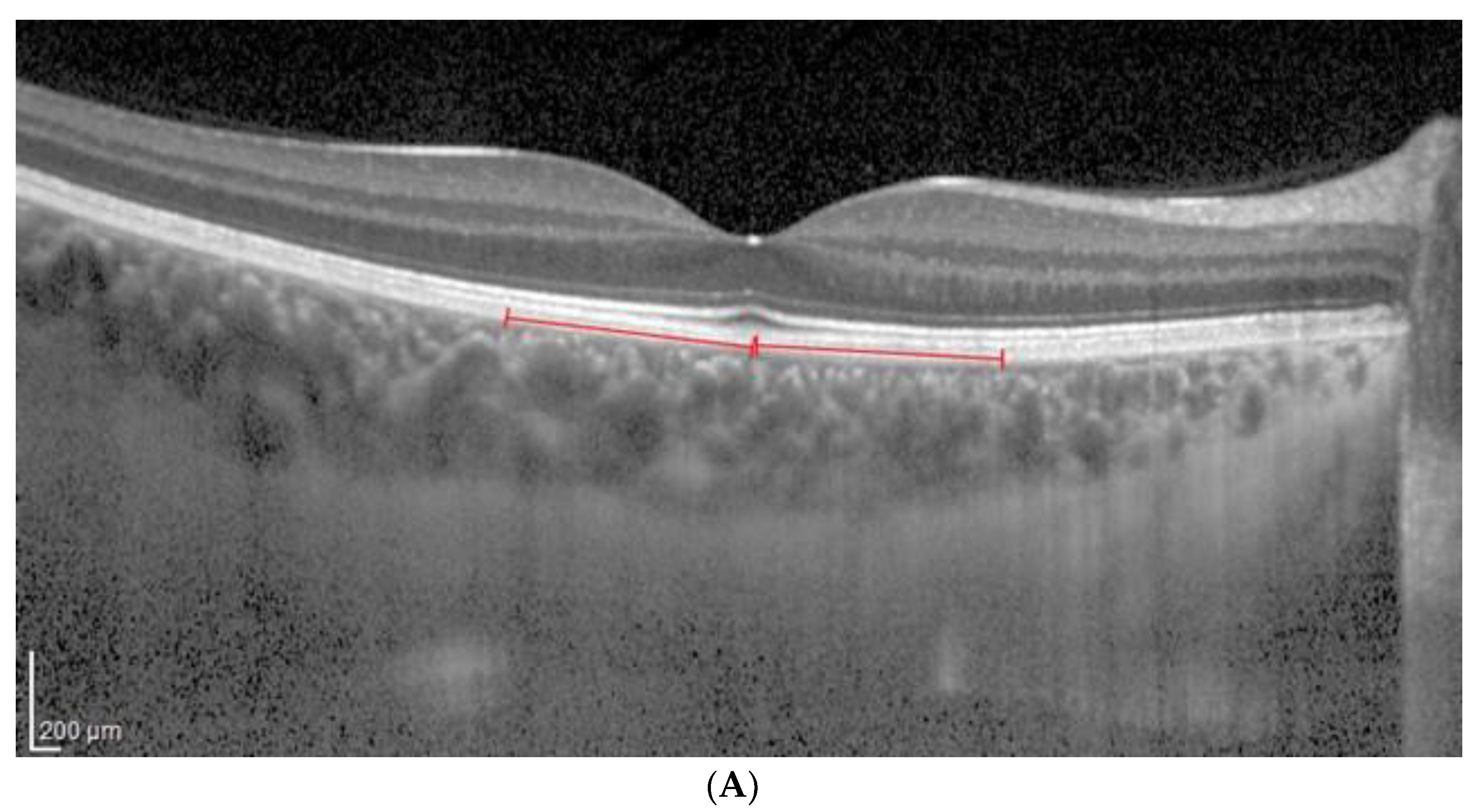 JCM | Free Full-Text | Impact of Brightness on Choroidal Vascularity Index