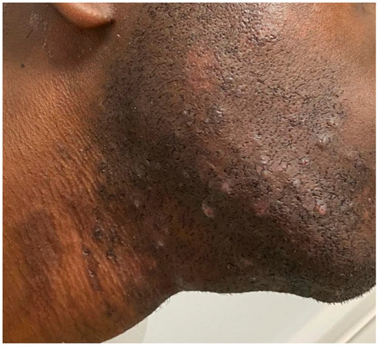 Hyper- and Hypopigmentation in a Subject with Fitzpatrick Skin ...