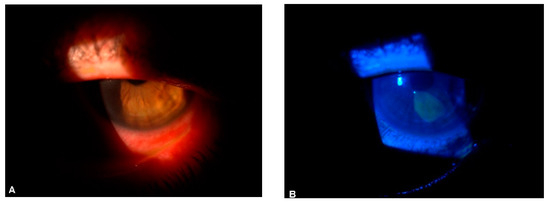 Unveiling Ocular Manifestations in Systemic Lupus Erythematosus
