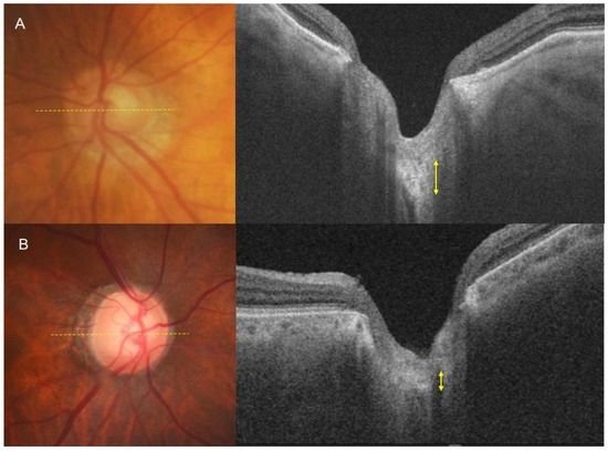 Characteristic Differences between Normotensive and Hypertensive Pseudoexfoliative Glaucoma
