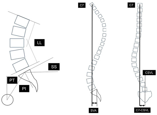 JCM | Free Full-Text | Clinical Outcomes of Lateral Lumbar Interbody ...