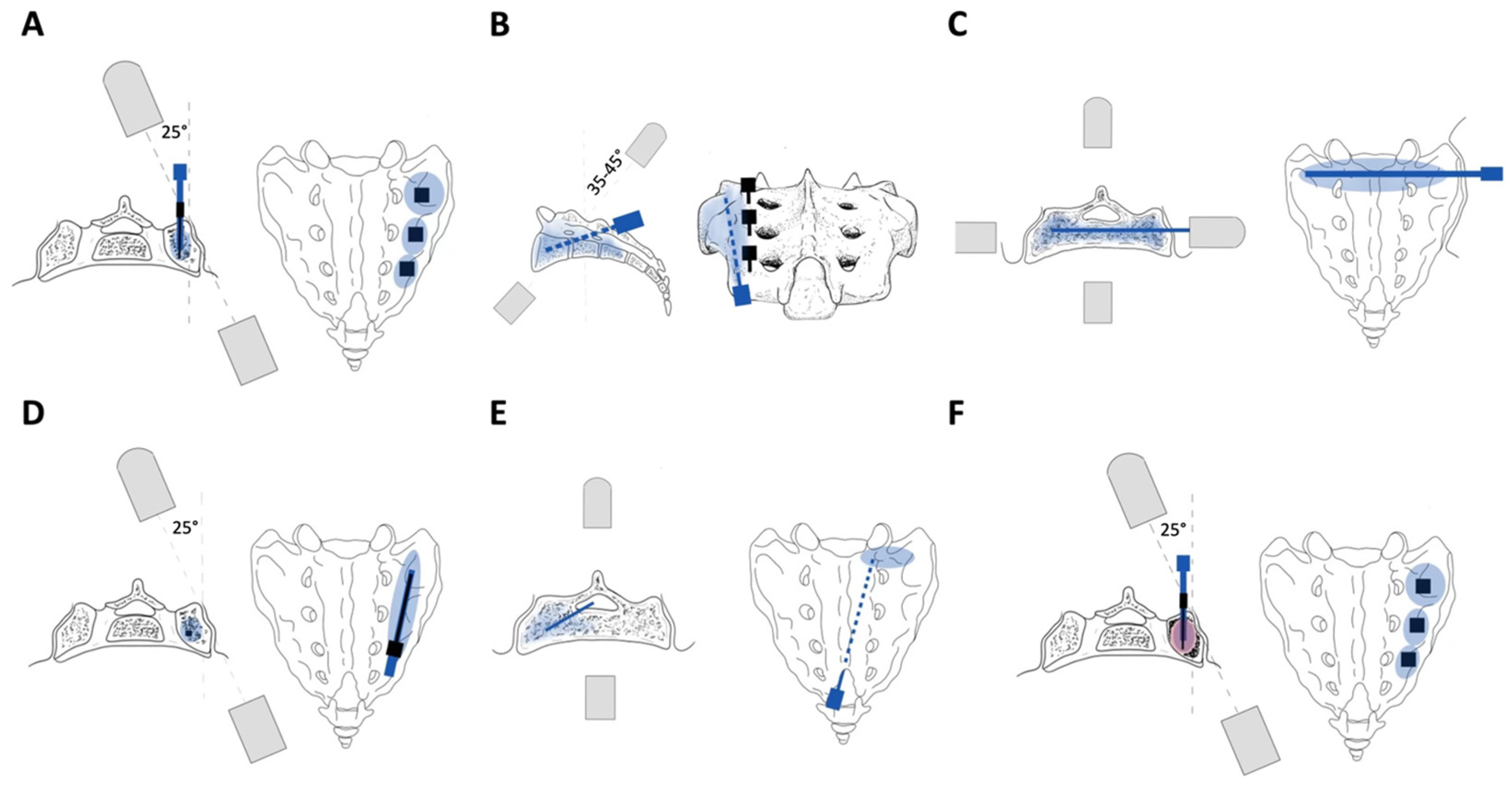 Sacroplasty for Sacral Insufficiency Fractures: Narrative Literature ...