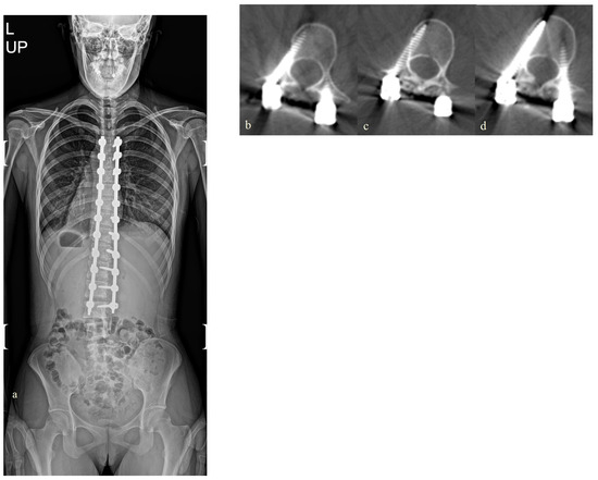 Novel Screw Placement Method for Extremely Small Lumbar Pedicles in ...