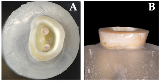 Influence of Cementation Mode and Ferrule Design on the Fatigue ...