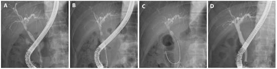 A Short Fully Covered Self-Expandable Metal Stent for Management of ...