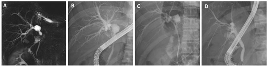 A Short Fully Covered Self-Expandable Metal Stent for Management of ...