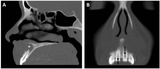 CT and MR Appearance of Teeth: Analysis of Anatomy and Embryology and ...
